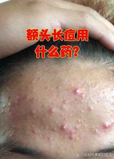 额头上长痘痘抹什么图标