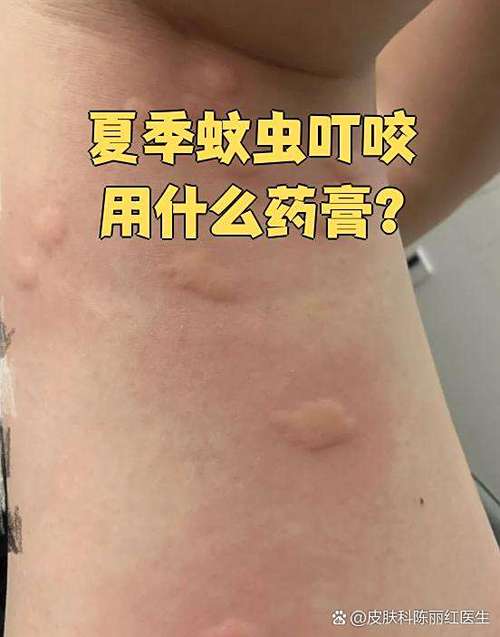 蚊虫叮咬止痒第一名