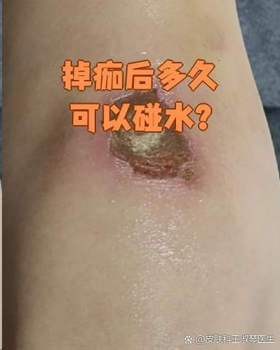 刚掉痂的皮肤能碰水吗截图