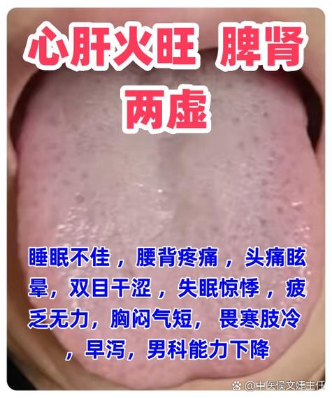 小孩流鼻血是心火重吗截图