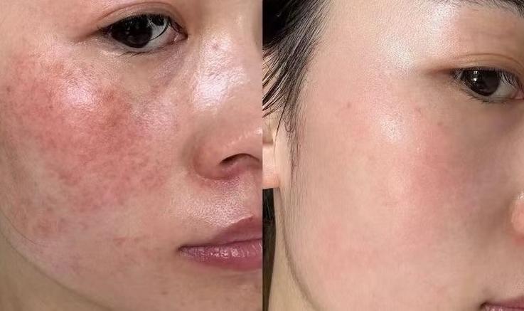 脸部皮肤修复截图