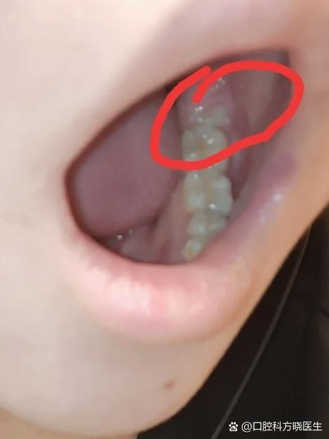一颗牙往里歪了怎么办截图