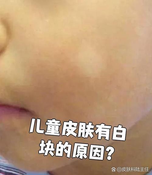 皮肤出现可小的白块图标