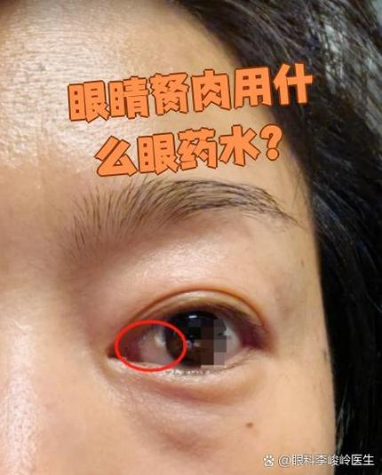眼胬肉怎么治疗最好图标