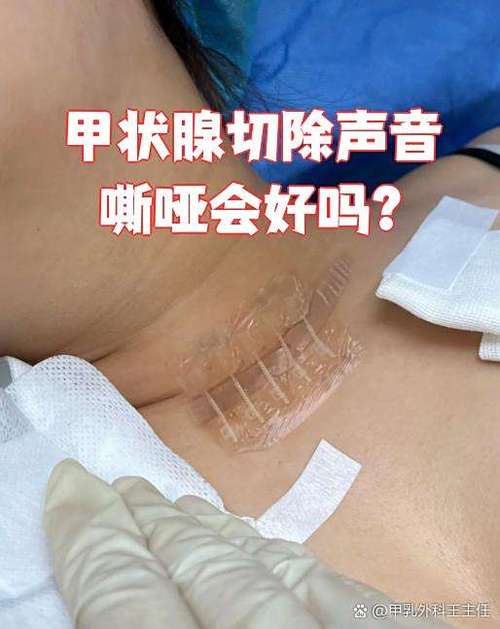 甲状腺切除声音嘶哑多久恢复图标