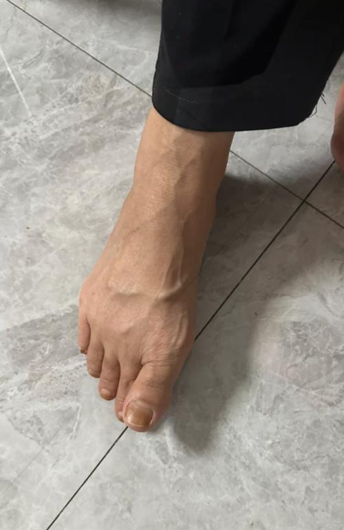 二三脚趾并在一起抽筋图标