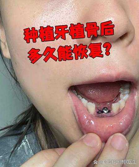 植骨多久能融合图标