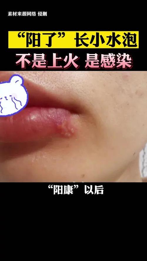 阳了得症状是什么截图