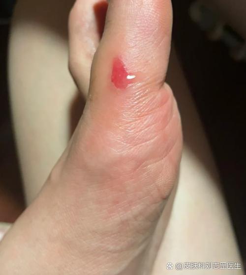 人手抓破皮要打针吗图标