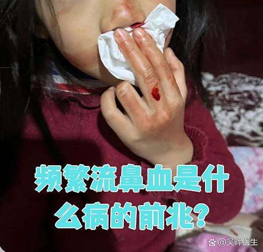 放鼻血是什么病的前兆图标