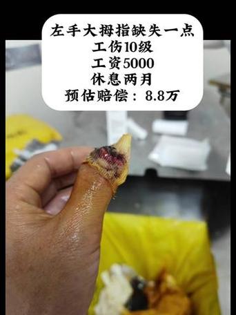 手指工伤赔偿图标