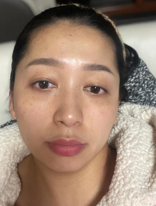 光凝术后可以洗脸吗