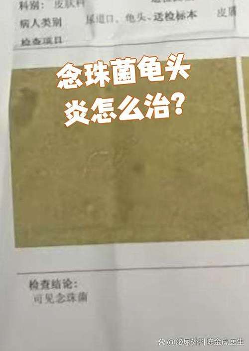 念珠菌感染什么症状图标