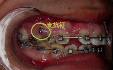 正畸骨钉周围有白色的膜图标