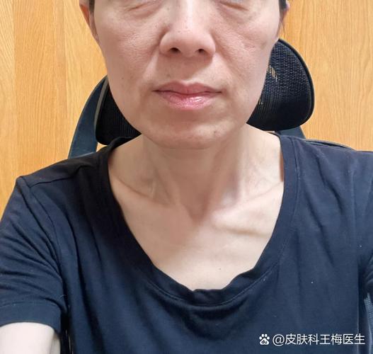 什么体质容易脸部下垂截图