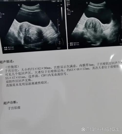 6周阴超只能看到暗区图标