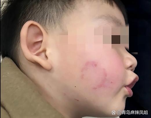 面部被咬伤会留疤吗截图