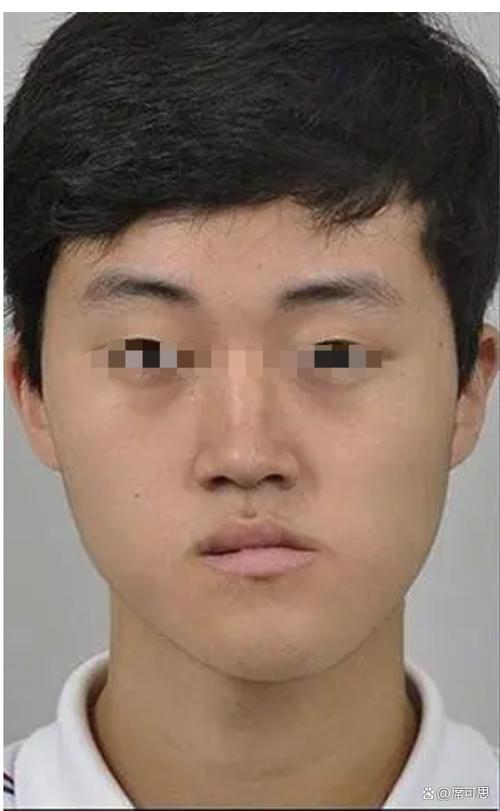 左右脸不对称嘴巴歪怎么矫正图标
