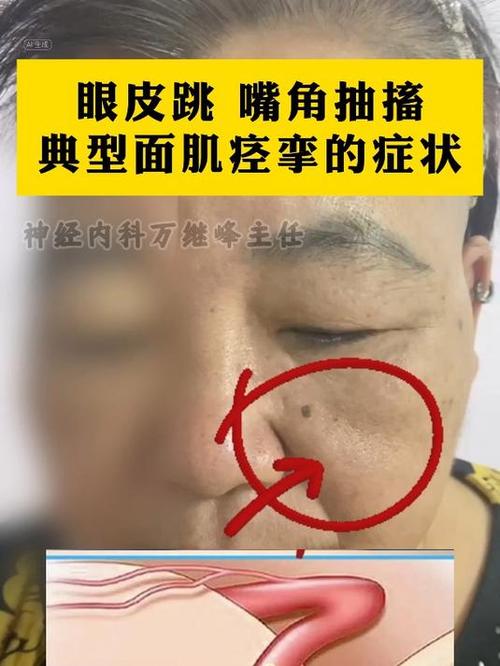眼皮跳和脸部肌肉抽搐