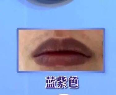 嘴唇变蓝是什么原因图标