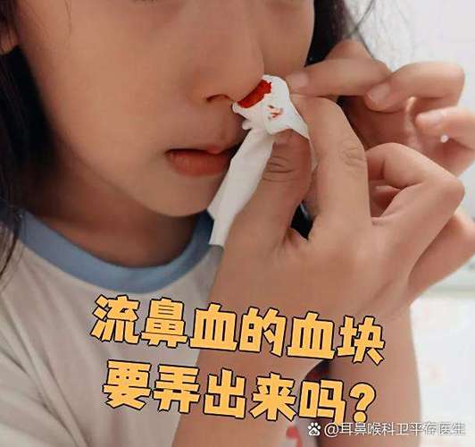 流鼻血血块要弄出来吗图标