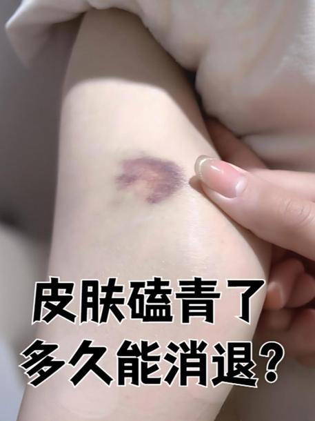 面部淤青多久能消退截图