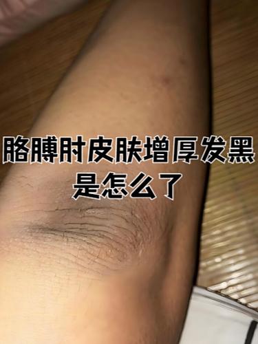 皮肤变黑的原因图标