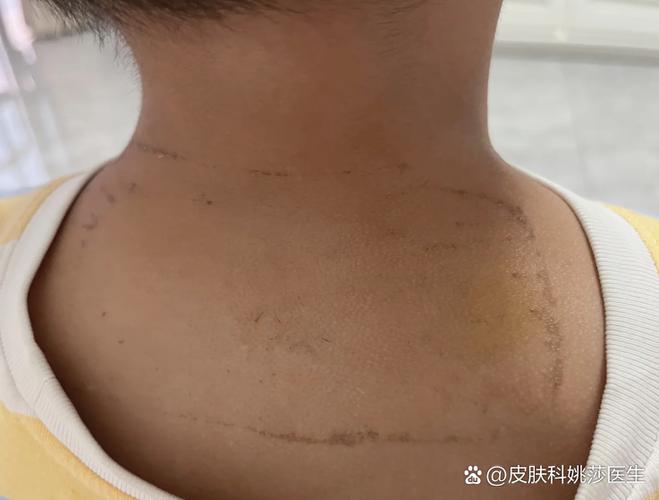 身上有膏药的胶印怎么弄掉
