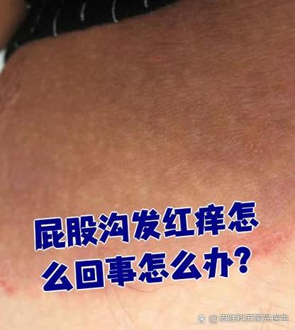 屁股沟痒烂是怎么回事图标