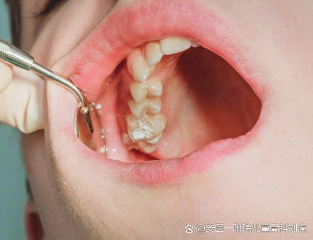 小孩能不能洗牙截图