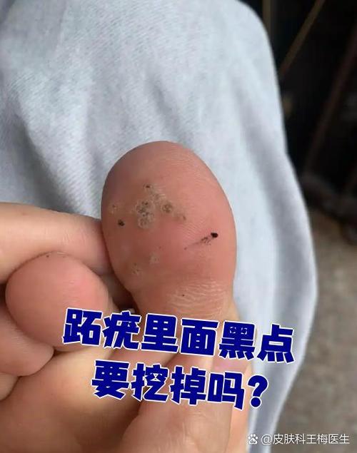 跖疣的治疗方法图标