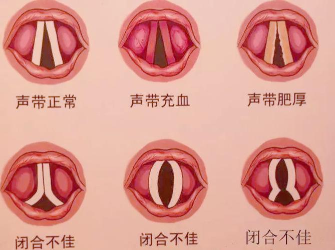 变声期的前兆截图
