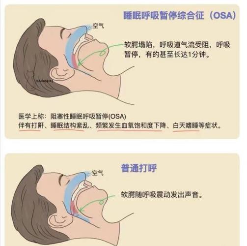 呼噜声太大的妙招截图