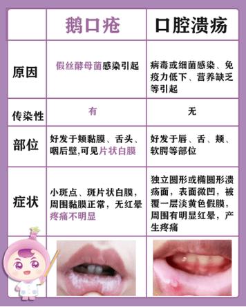 白苔与鹅口疮区分图片图标