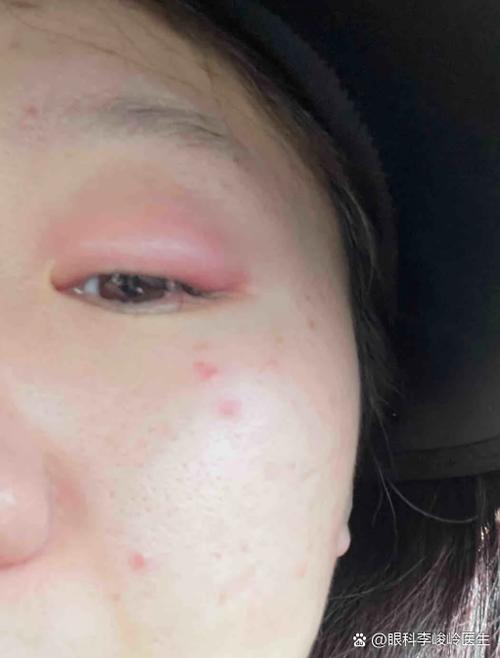 眼部过敏红肿痒怎么办图标