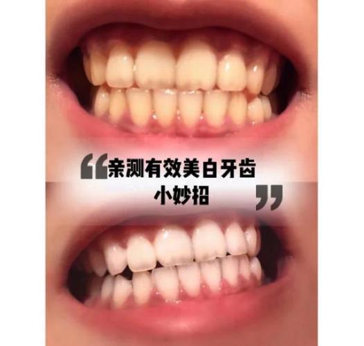 牙齿怎么才可以变白缩略图