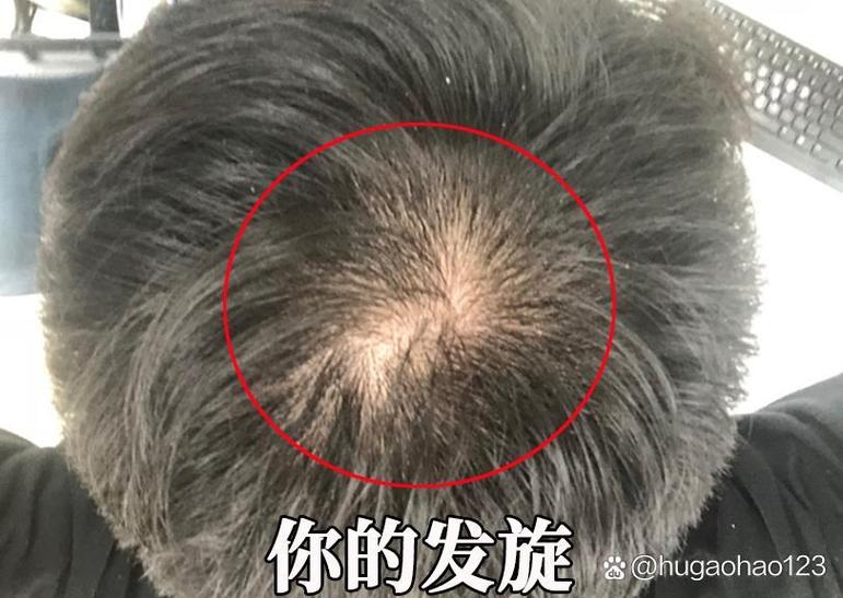发旋一碰掉发