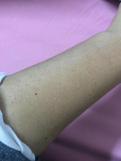 手臂上紫色淤血要警惕截图