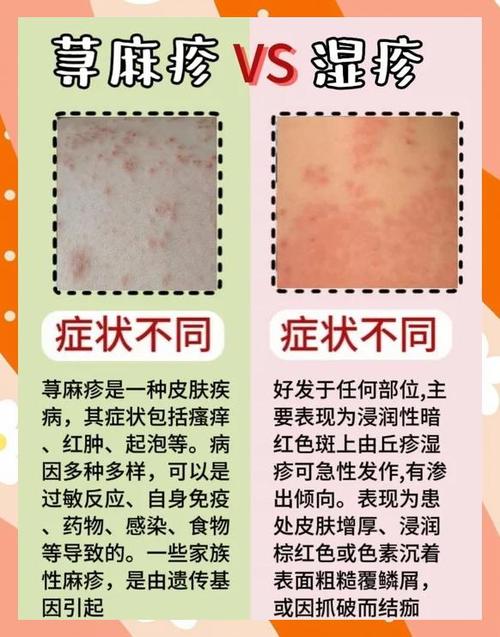 荨麻疹快速消退方法图标