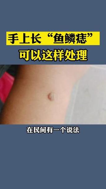 鱼鳞痣怎么去除图标