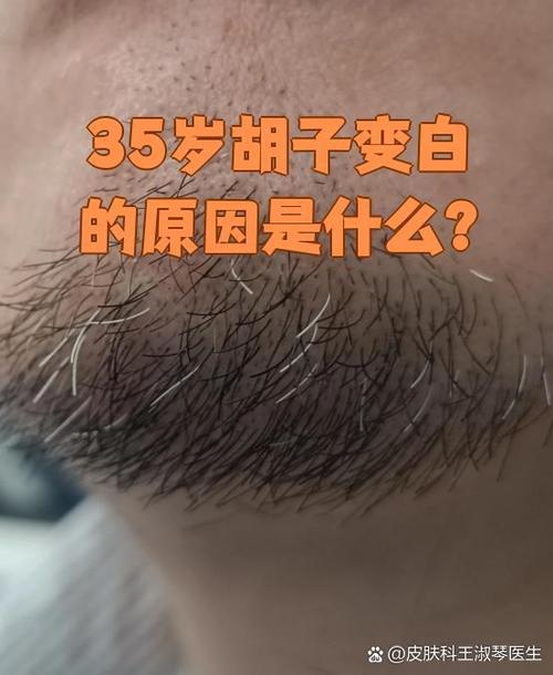 30岁胡子变白是肾虚吗图标