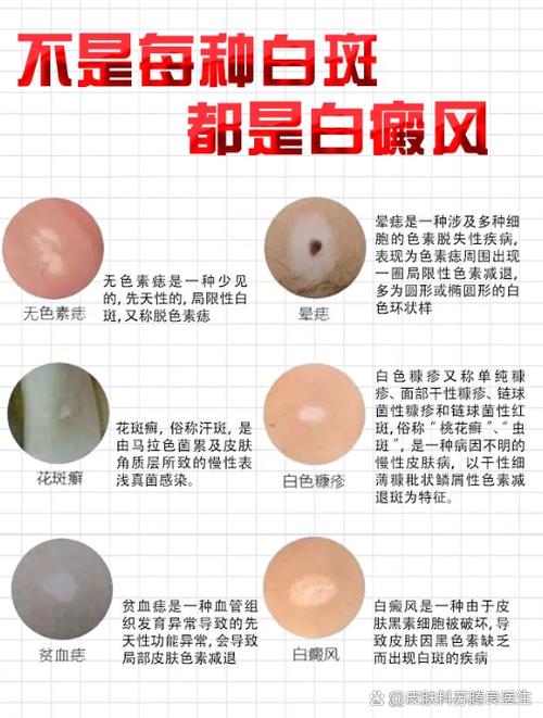 皮肤局部变白的原因