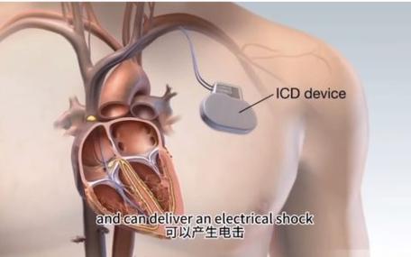 icd植入术在医保范围内吗图标