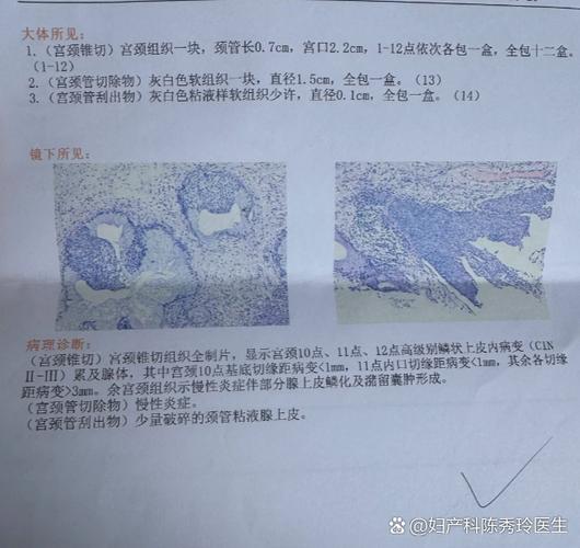 宫颈cin2—3累及腺体图标