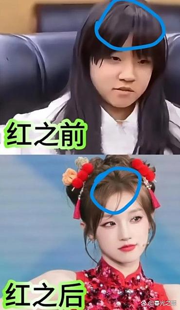 女孩天生白色刘海确认罕见病