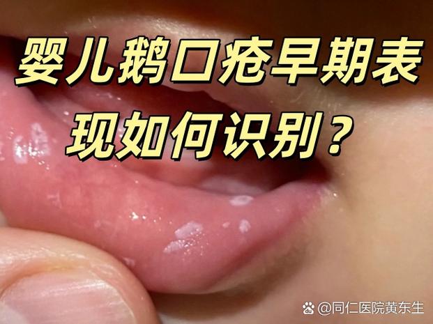 怎么判断婴儿鹅口疮图标