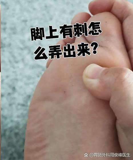 腿上扎了一个刺挑不出来怎么办图标