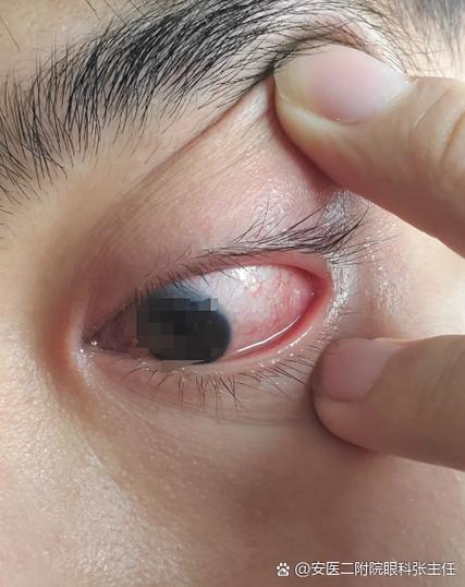 眼睛磨得慌有异物感截图