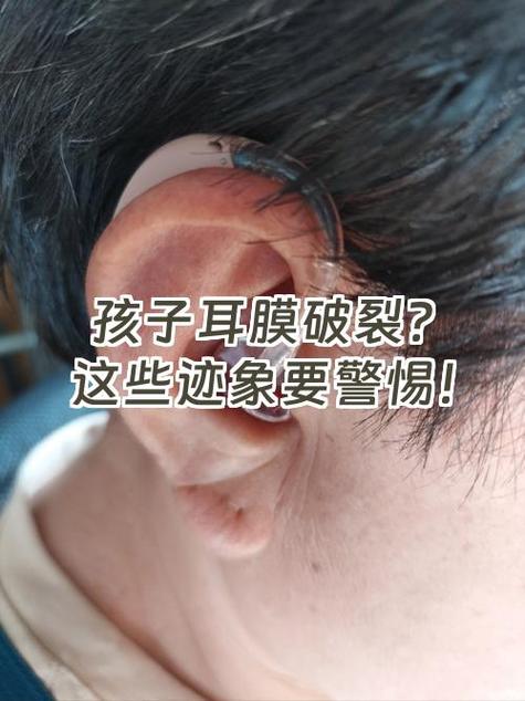 耳膜破裂修复手术会有后遗症吗截图