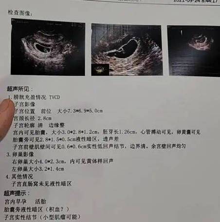 非纯液性暗区是囊肿吗图标